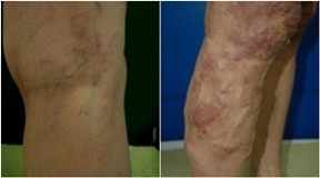 #5-2. Varicose Veins; Symptomatic and physical presentations and classification | D&PS